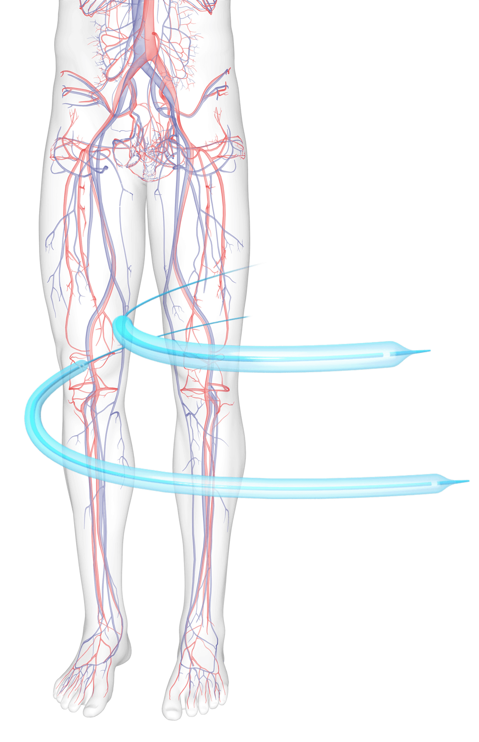 Balon Cardiologico Saber – Endovas